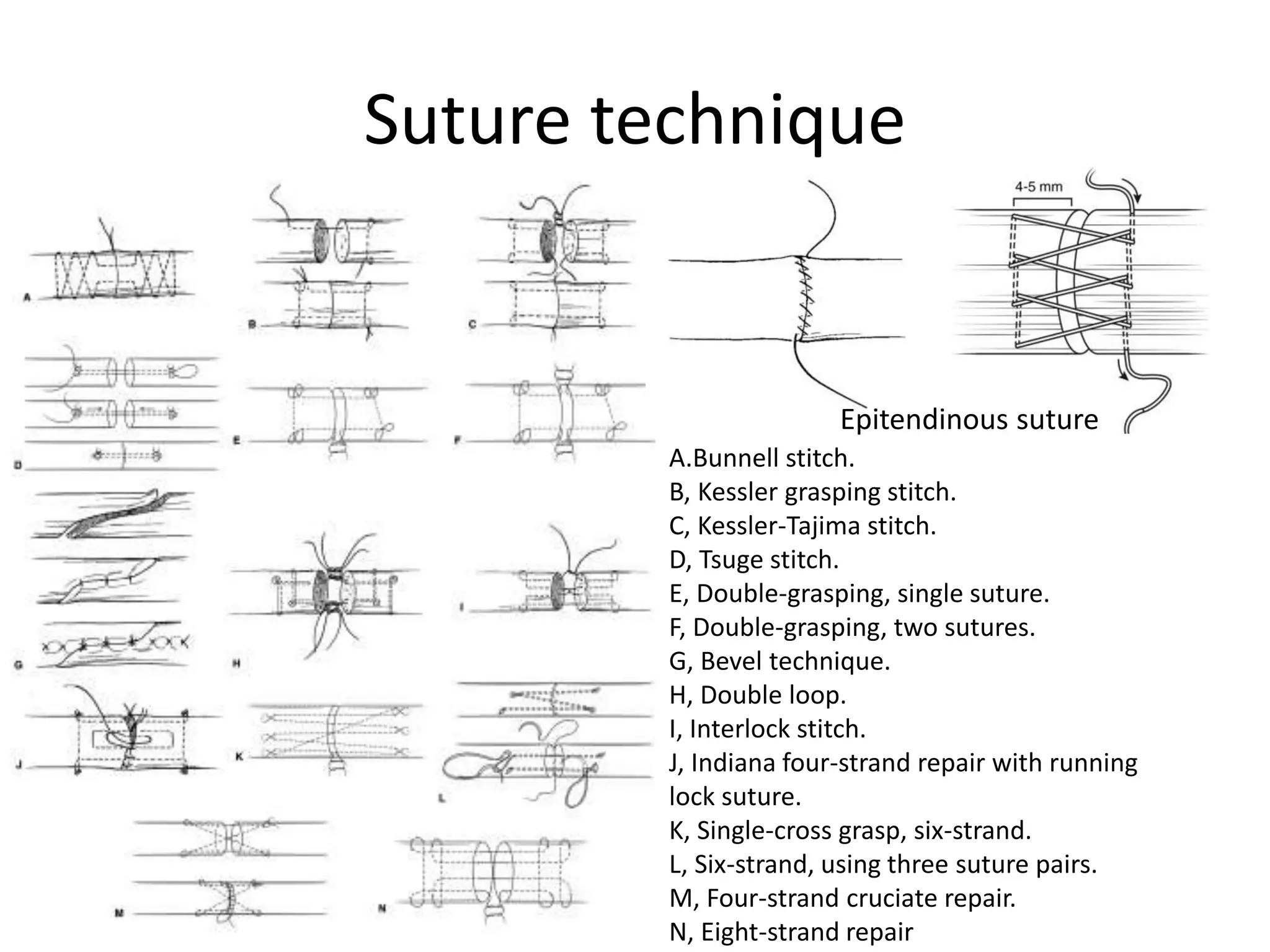 JOURNAL CLUB ON FLEXOR TENDON INJURIES.pptx