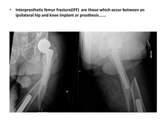Journal club on IFF.pptx