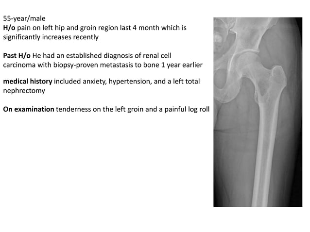 Pathologic Fractures due to metastasis and its management .pptx