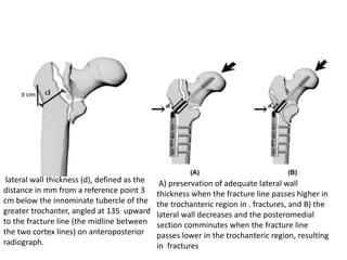 Journal Club on Unstable trochanteric fractures | PPTX