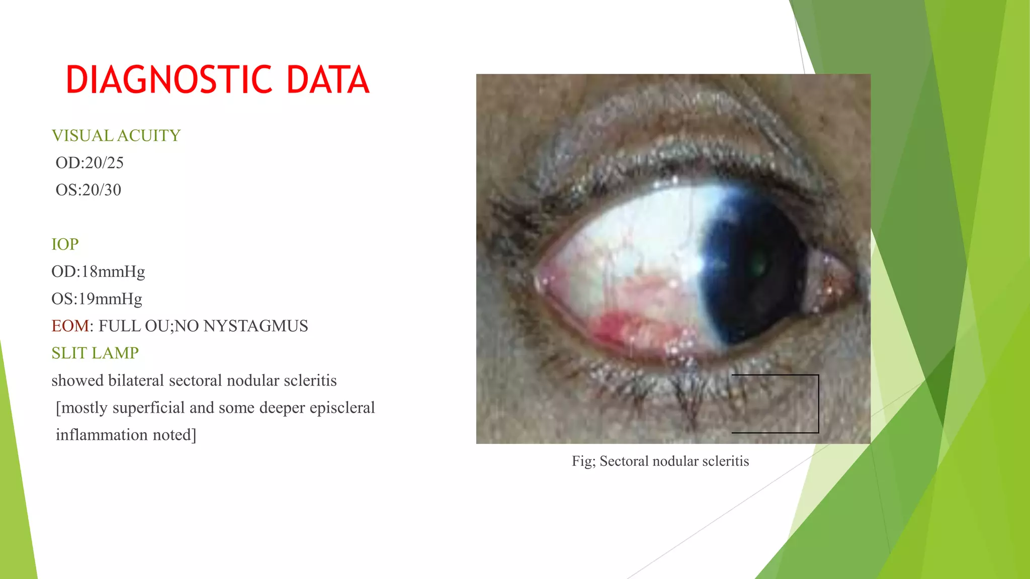 case review of scleritis | PPTX