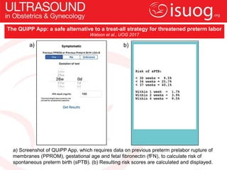 UOG Journal Club: September 2017 | PPT