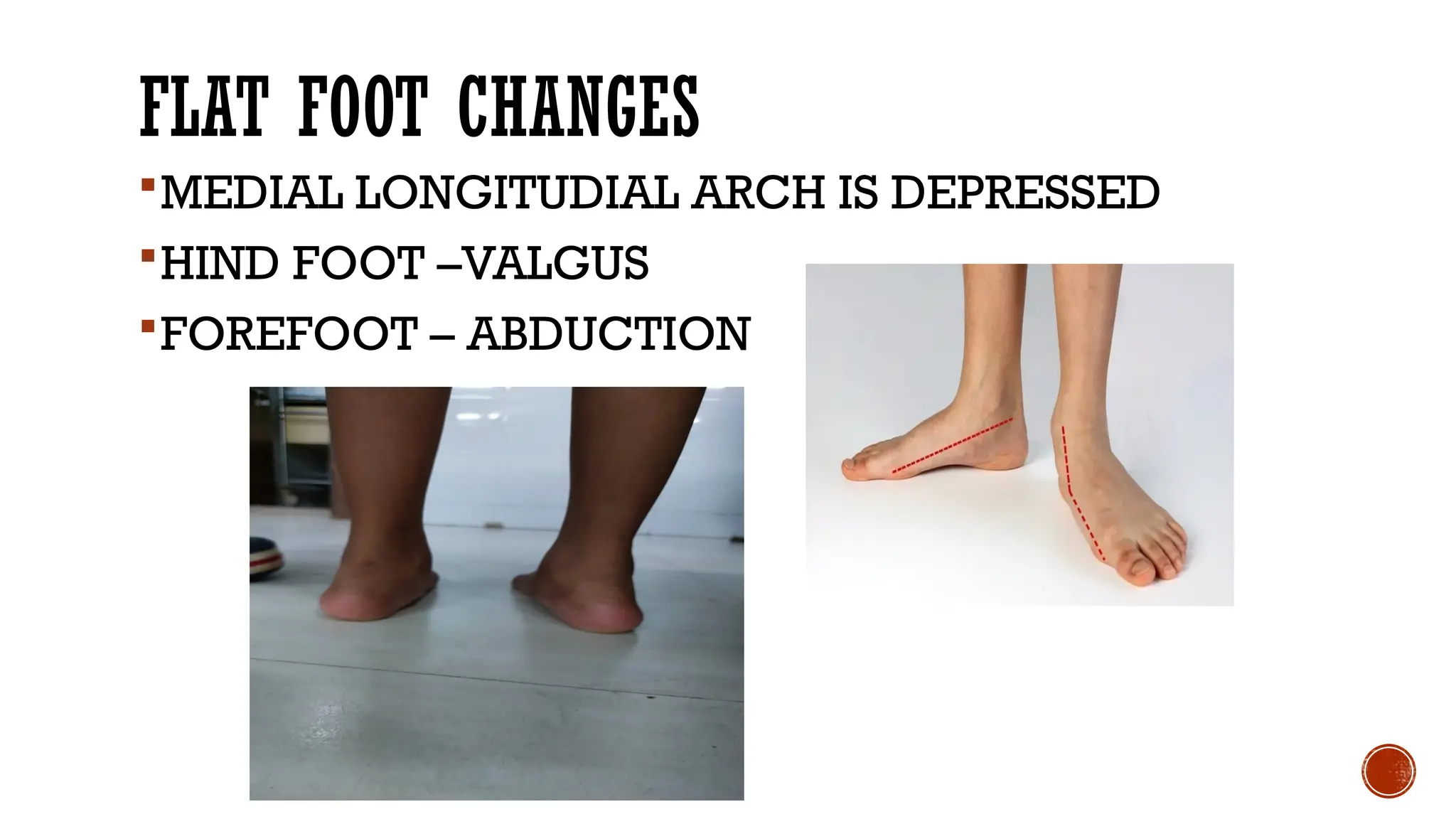 JOURNAL ON FLAT FOOT with planuovalgus deformities .pptx