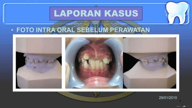 JOURNAL ORTHO LAPSUS.pptx