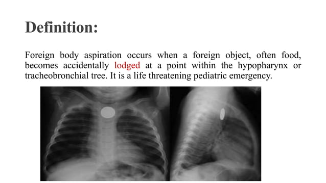 FOREIGN BODY ASPIRATION JOURNAL PRSTN.pptx