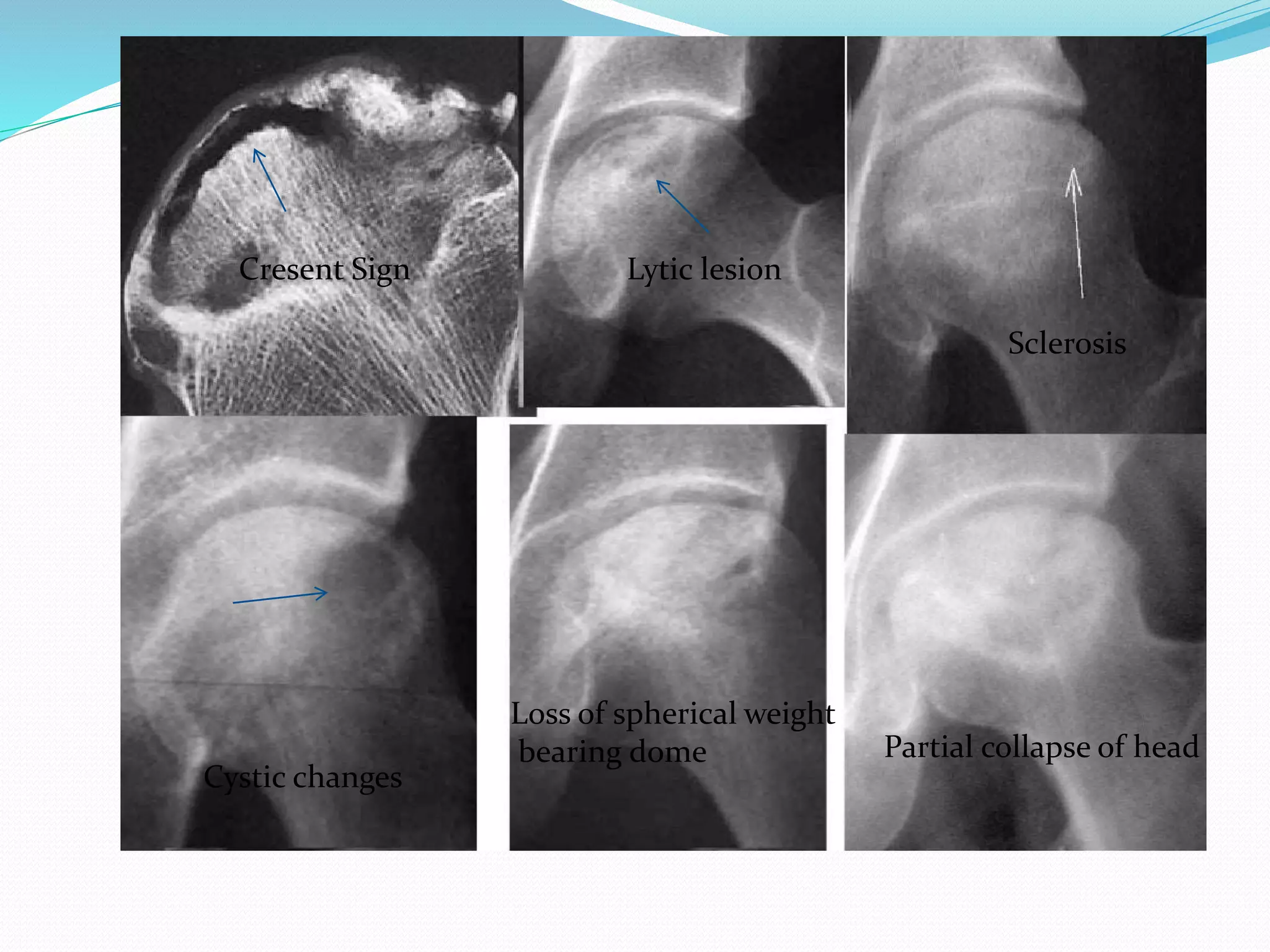 Seminar on Osteonecrosis of femoral head.pptx