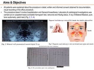 journal presentation on traumatic Tympanic membrane perforations.pptx
