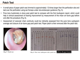 journal presentation on traumatic Tympanic membrane perforations.pptx