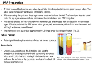 journal presentation on traumatic Tympanic membrane perforations.pptx