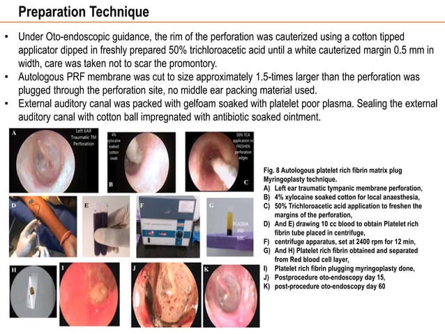 journal presentation on traumatic Tympanic membrane perforations.pptx