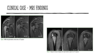 Journal presentation on Conservative Management of Partial Articular ...