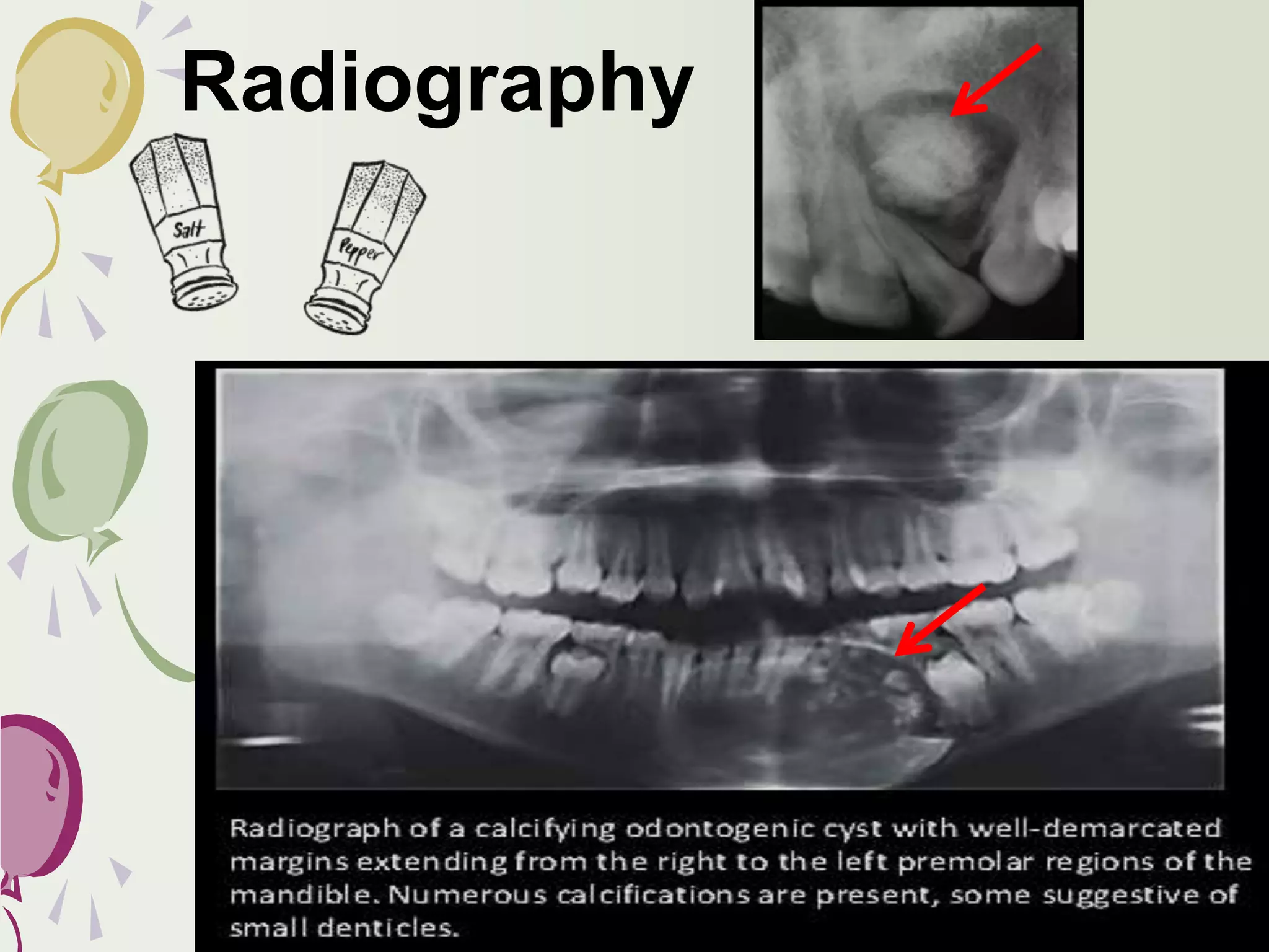 calcifying odontogenic cyst | PPTX