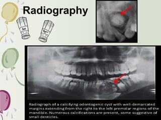 Calcifying Odontogenic Cyst Clinical Picture