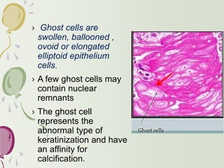 Ghost Cells Calcifying Odontogenic Cyst