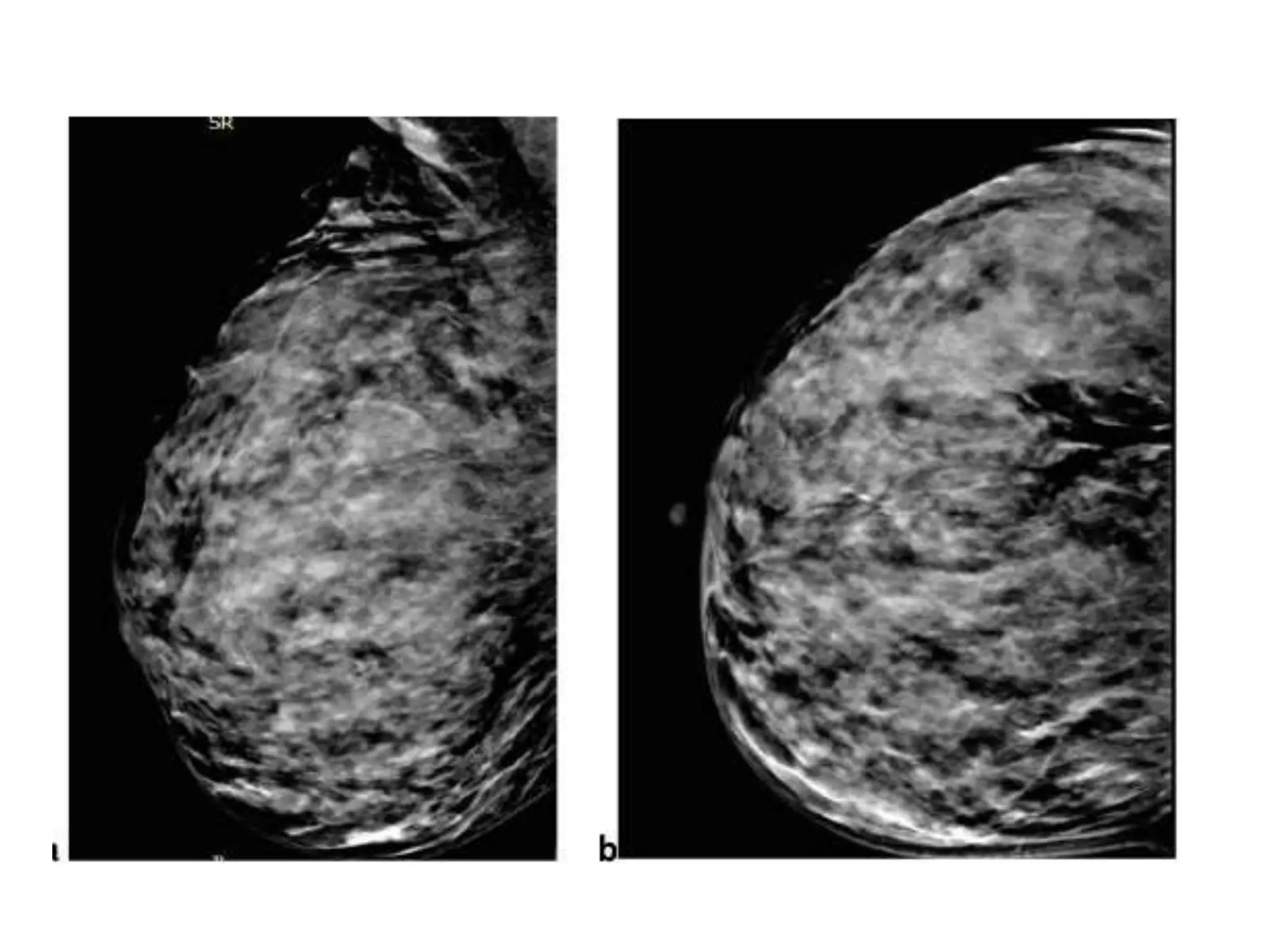 Tomosynthesis vs digital mammography efficacy comparison using birads.pptx | Cancer | Diseases ...