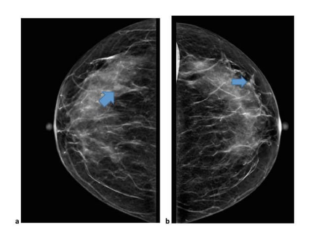 Tomosynthesis vs digital mammography efficacy comparison using birads.pptx