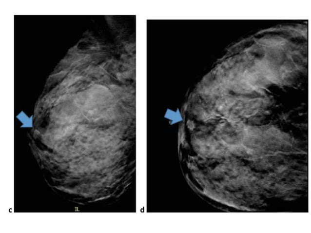 Tomosynthesis vs digital mammography efficacy comparison using birads.pptx