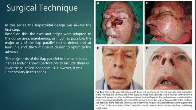 Journal Reading- keystone flap.pptx | Surgery | Medical Health