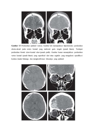 Imaging pediatric head trauma-Indonesia Version | PDF