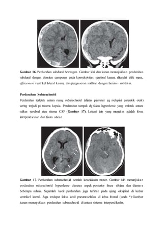 Imaging pediatric head trauma-Indonesia Version | DOCX
