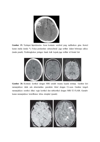 Imaging pediatric head trauma-Indonesia Version | PDF