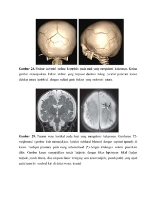 Imaging pediatric head trauma-Indonesia Version | PDF