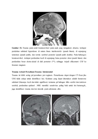 Imaging pediatric head trauma-Indonesia Version | PDF