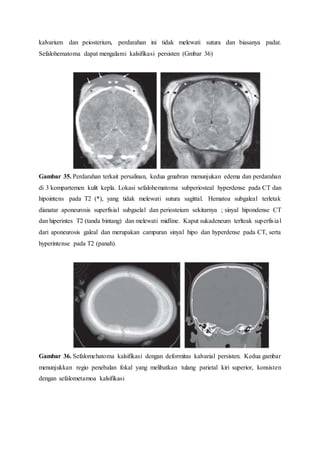 Imaging pediatric head trauma-Indonesia Version | PDF