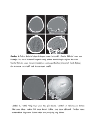 Imaging pediatric head trauma-Indonesia Version | PDF