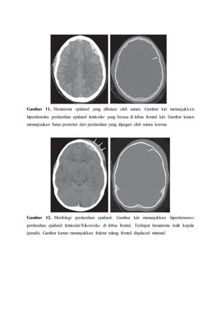 Imaging pediatric head trauma-Indonesia Version | PDF