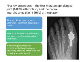 Journal reading New trends in Orthopaedic management of diabetic foot.pptx