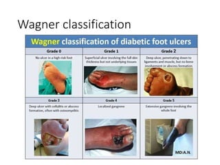 Journal reading New trends in Orthopaedic management of diabetic foot.pptx