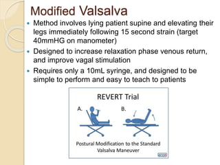 Journal Review - REVERT Trial: Modified Valsalva for Supraventricular ...