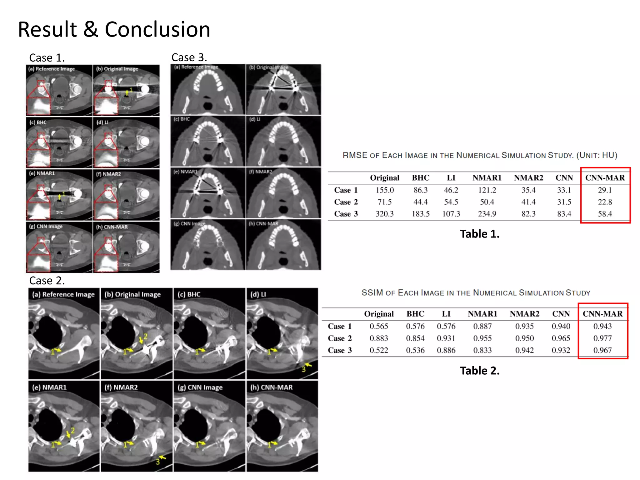Convolutional Neural Network Based Metal Artifact Reduction In X Ray Computed Tomography Ppt
