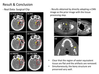 Convolutional neural network based metal artifact reduction in x ray computed tomography | PPT