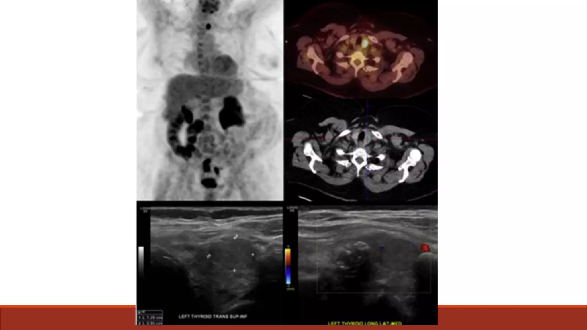 Journal ultrasound stratification of the fdg avid thyroid | PPT