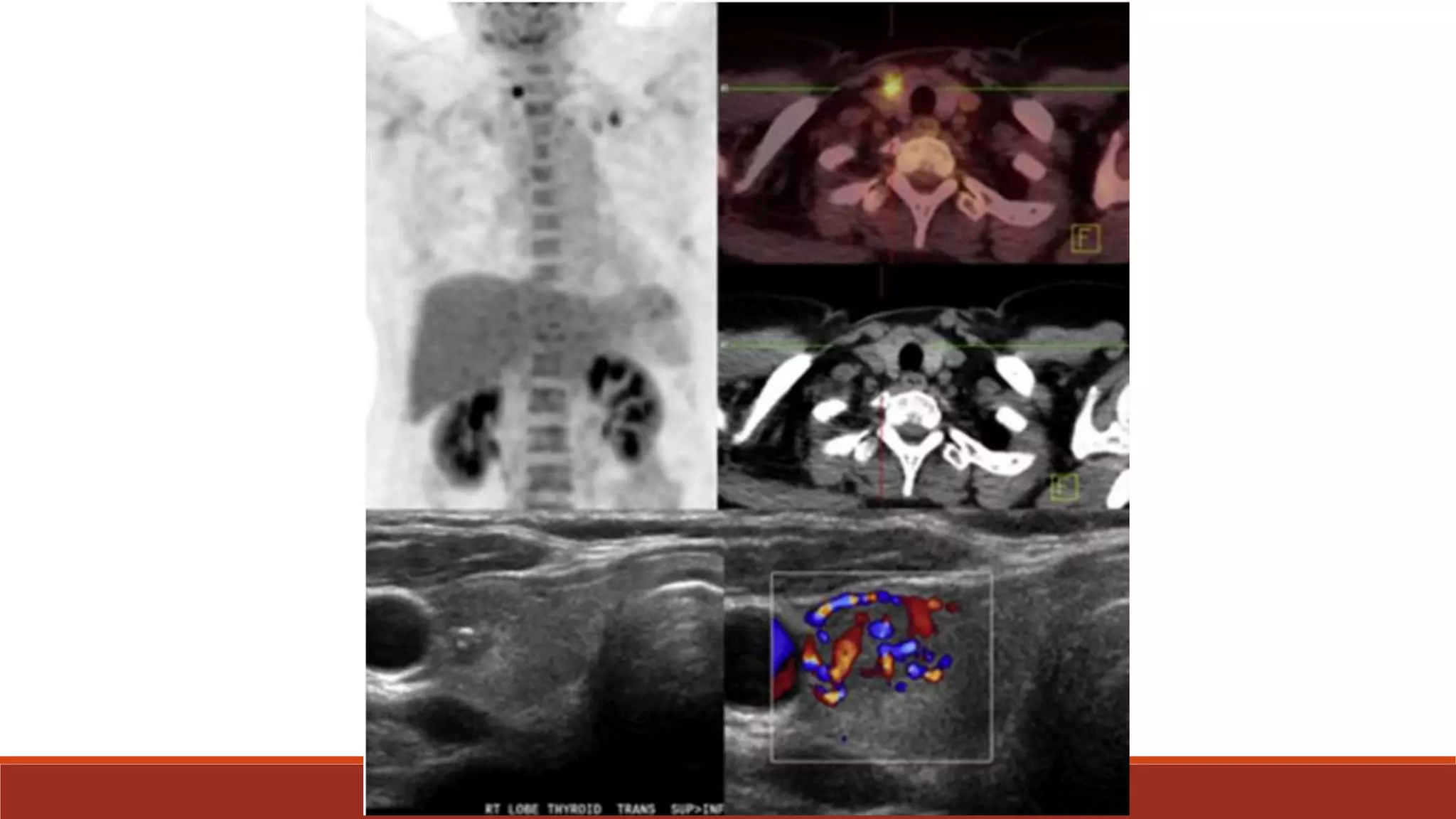 Journal ultrasound stratification of the fdg avid thyroid | PPT
