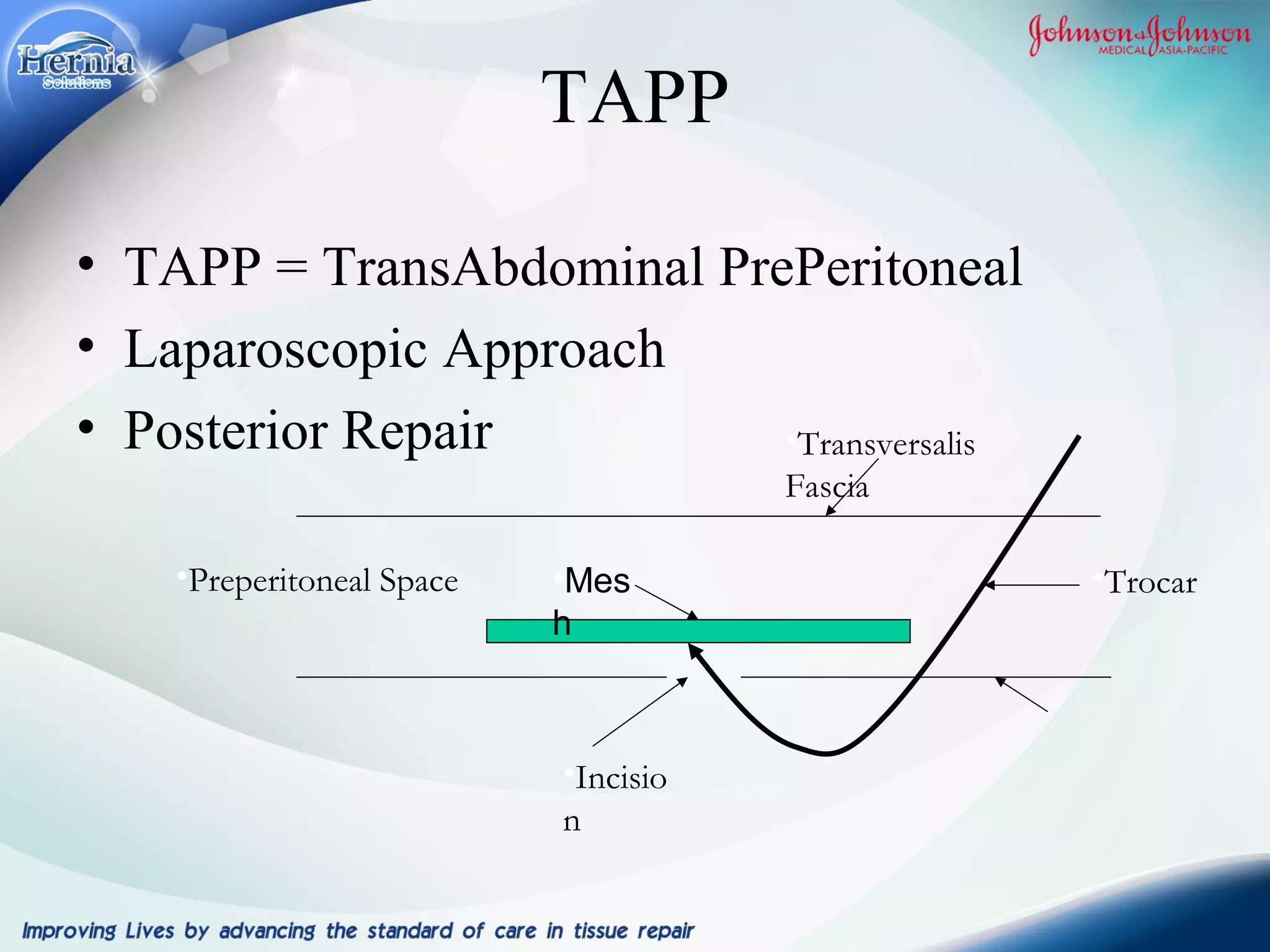MY JOURNEY WITH HERNIA SURGERY | PPT