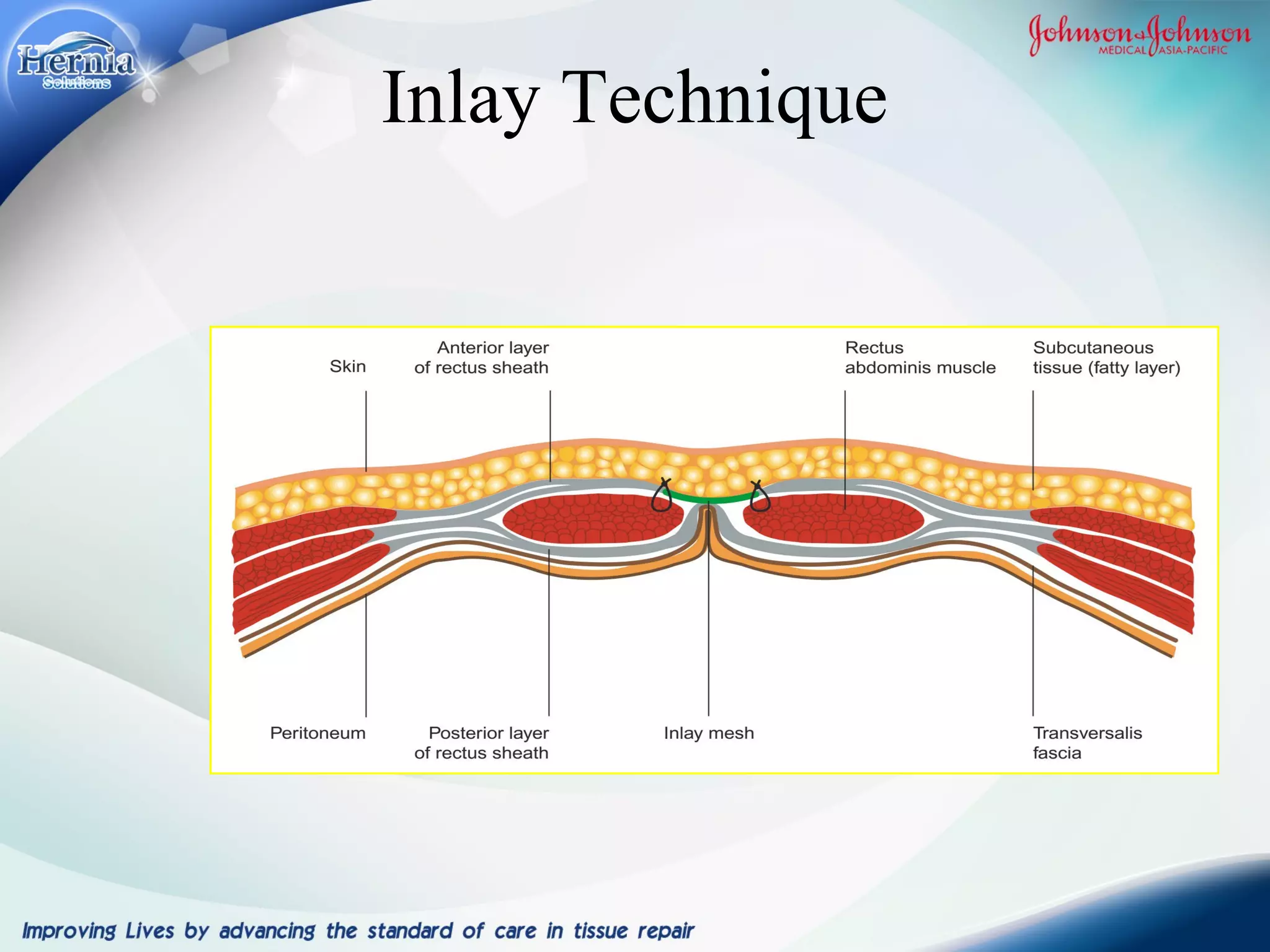 MY JOURNEY WITH HERNIA SURGERY | PPT