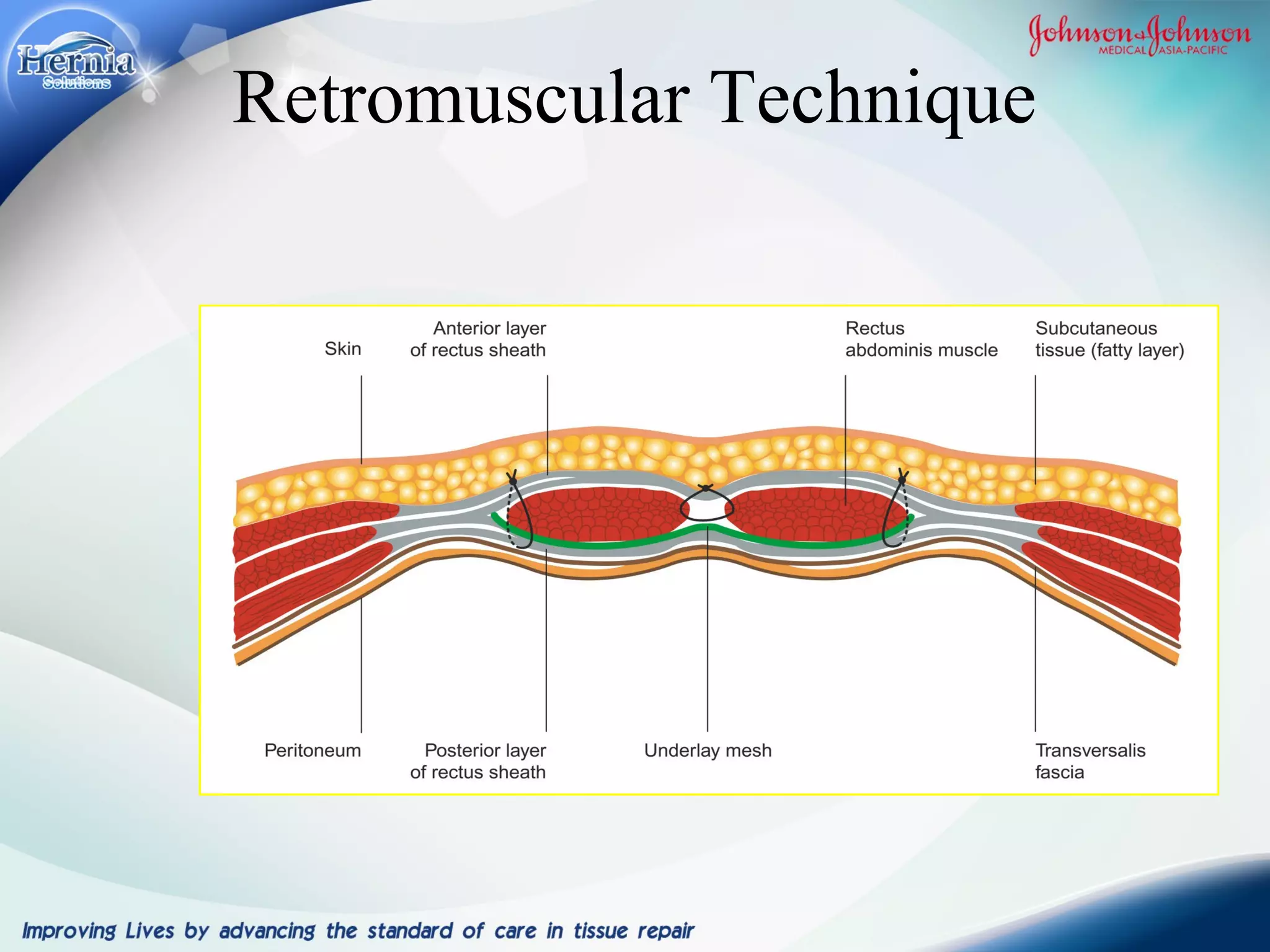 MY JOURNEY WITH HERNIA SURGERY | PPT