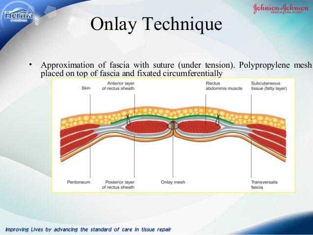 MY JOURNEY WITH HERNIA SURGERY