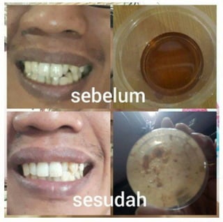 OBAT SARIAWAN ALAMI JOYPOLINSE | PDF