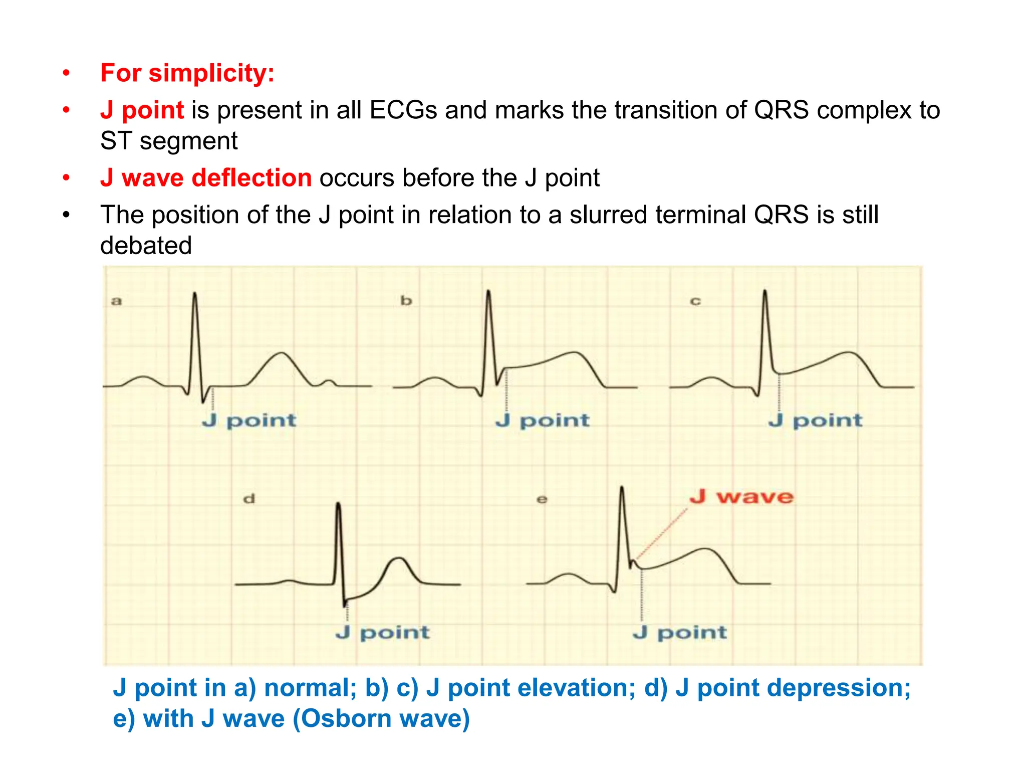 J POINT IN ECG AND ITS INERPRETATION IN ECG | PPTX
