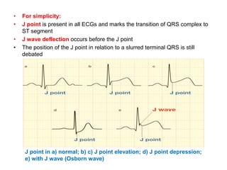 J POINT IN ECG AND ITS INERPRETATION IN ECG | PPTX