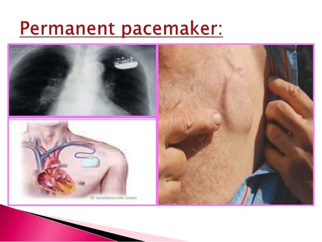 Jp's pacemaker