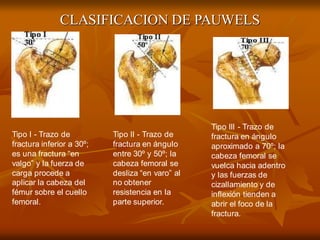 Clasificación fractura de cadera