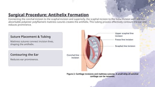 Journal Reading of Otoplasty evaluation and mangement | PPTX