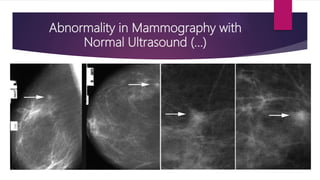 Variability And Errors When Applying The BIRADS Mammography ...