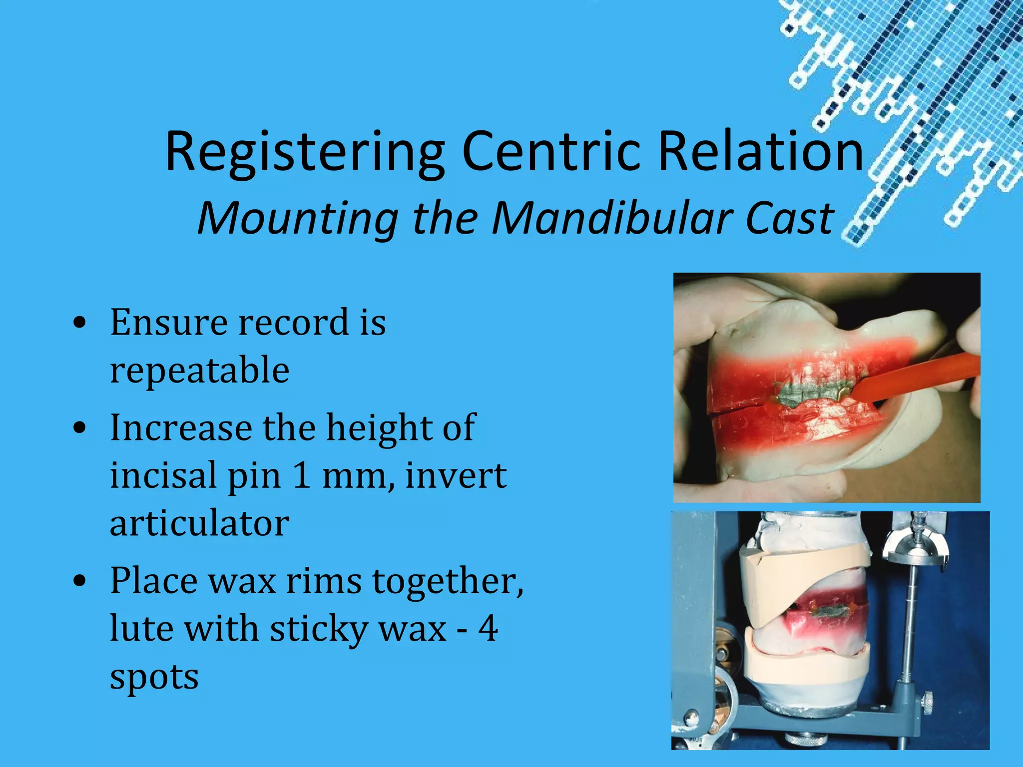 Jaw relation in complete dentures | PPT