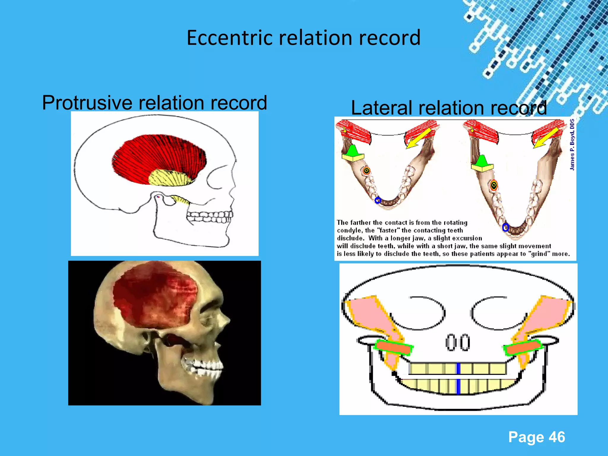 Jaw relation in complete dentures | PPT